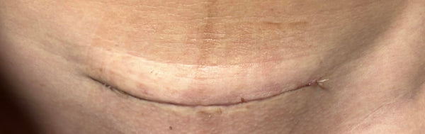 Losveo™ - Silicone Scar Sheets